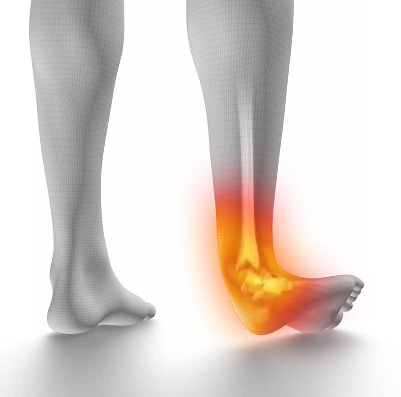 Ankle Sprain - A Complete Guide