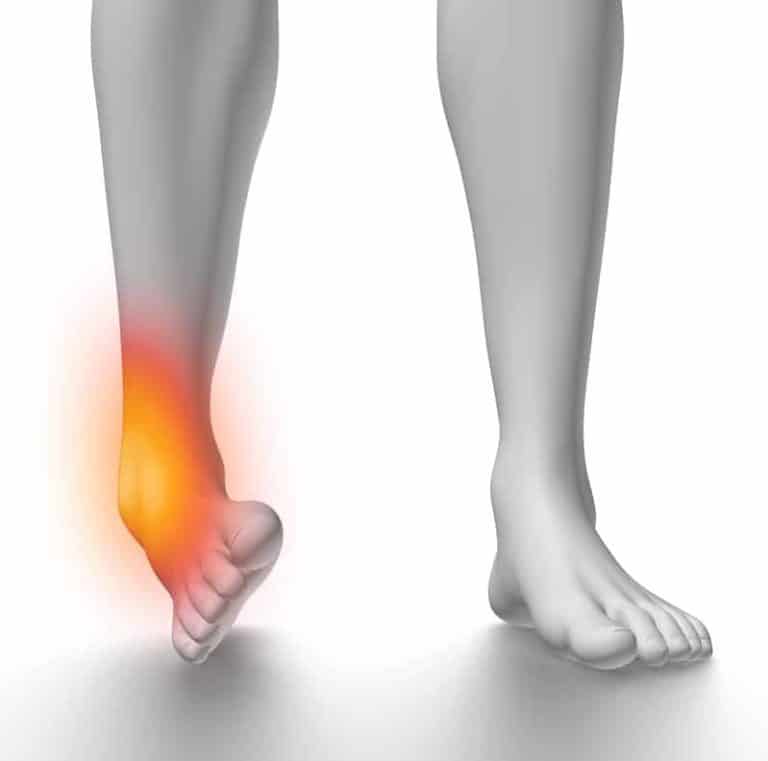 Ankle Sprain - A Complete Guide